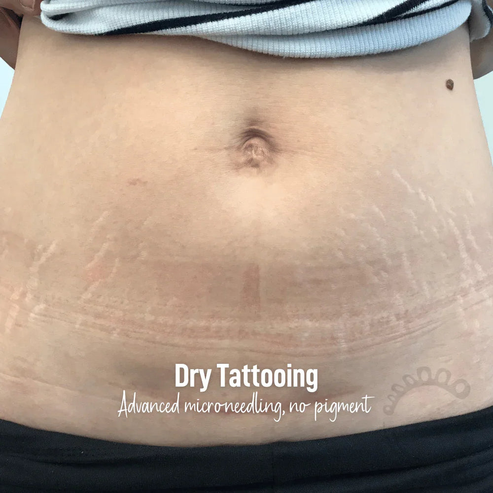 Botched Ink® Saline Tattoo Removal for Microblading, Eyebrows, Lips